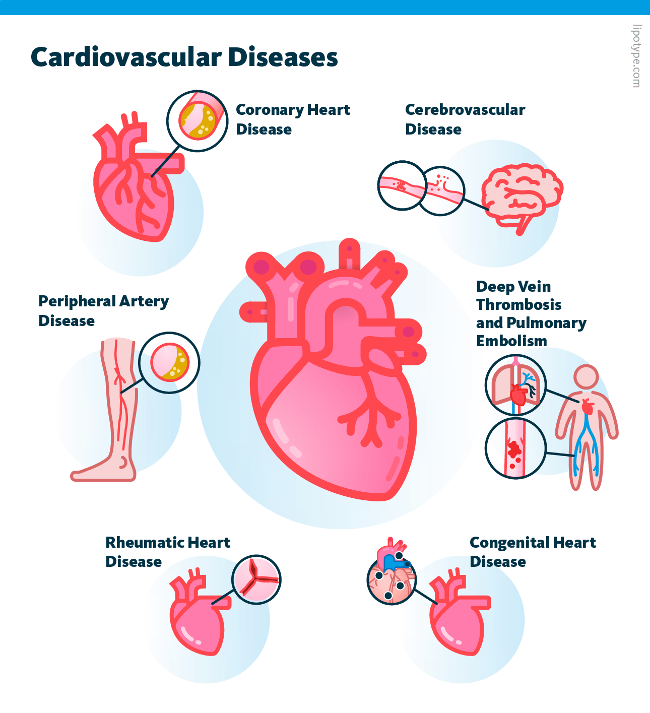 Lipidomics of cardiovascular diseases - Lipotype GmbH